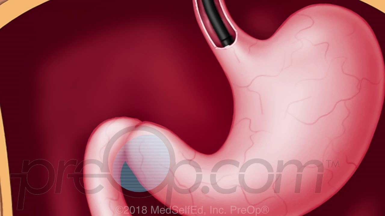 Upper Gi Endoscopy Egd Preop Surgery Patient Education Engagement
