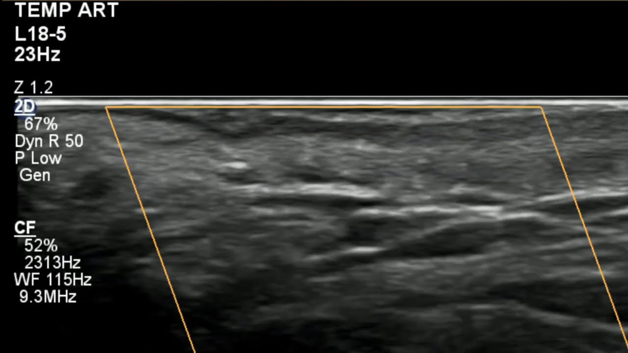 Temporal Artery Ultrasound