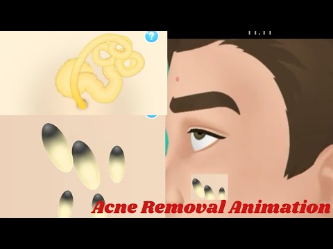 Asmr Acne Big Blackhead Removal Animation Youtube
