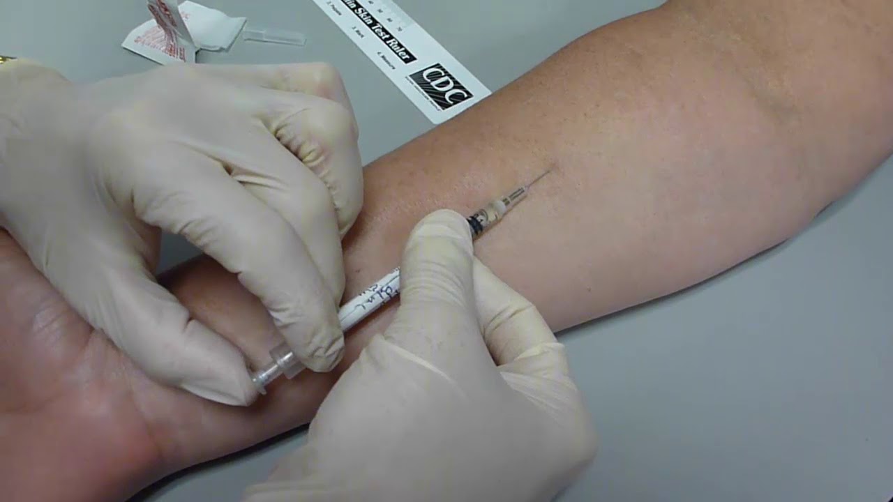 Tb Skin Test Placement Youtube