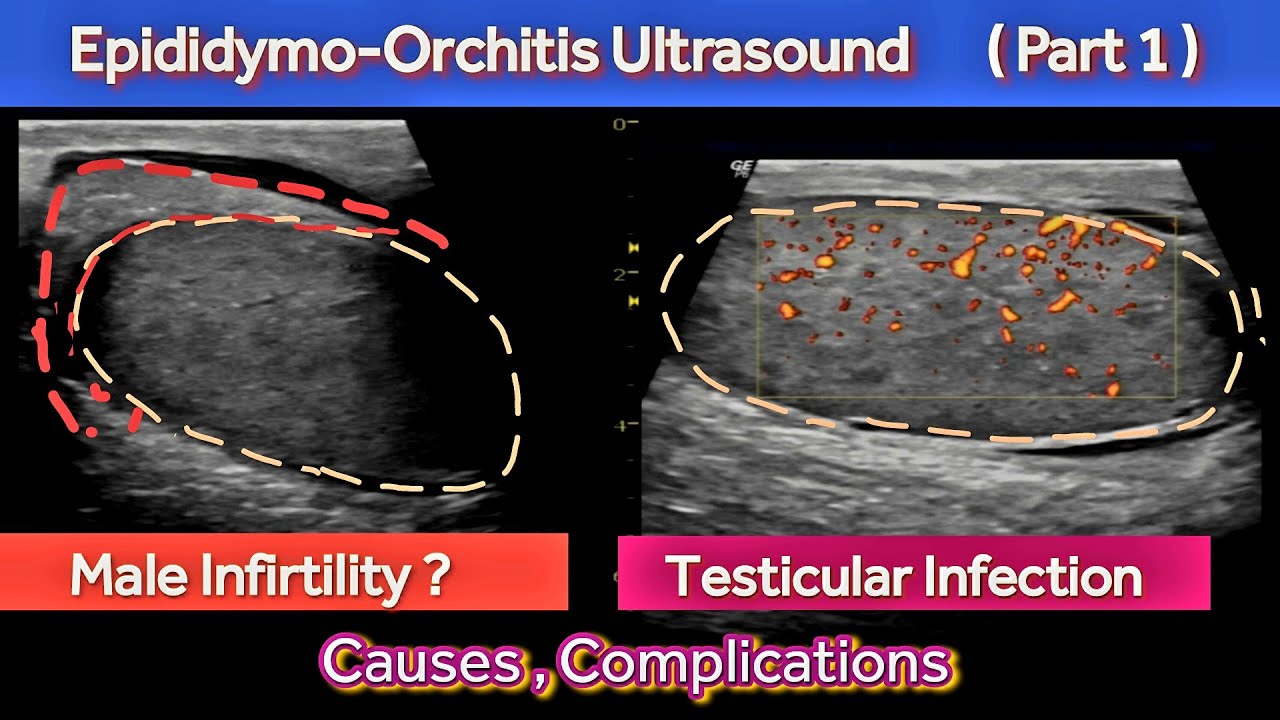 Epididymo Orchitis Testis Ultrasound
