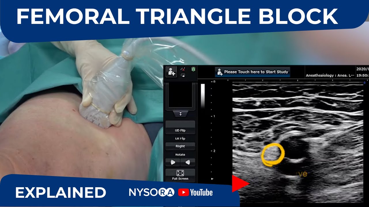 Ultrasound Guided Femoral Triangle Nerve Block Nysora S Regional