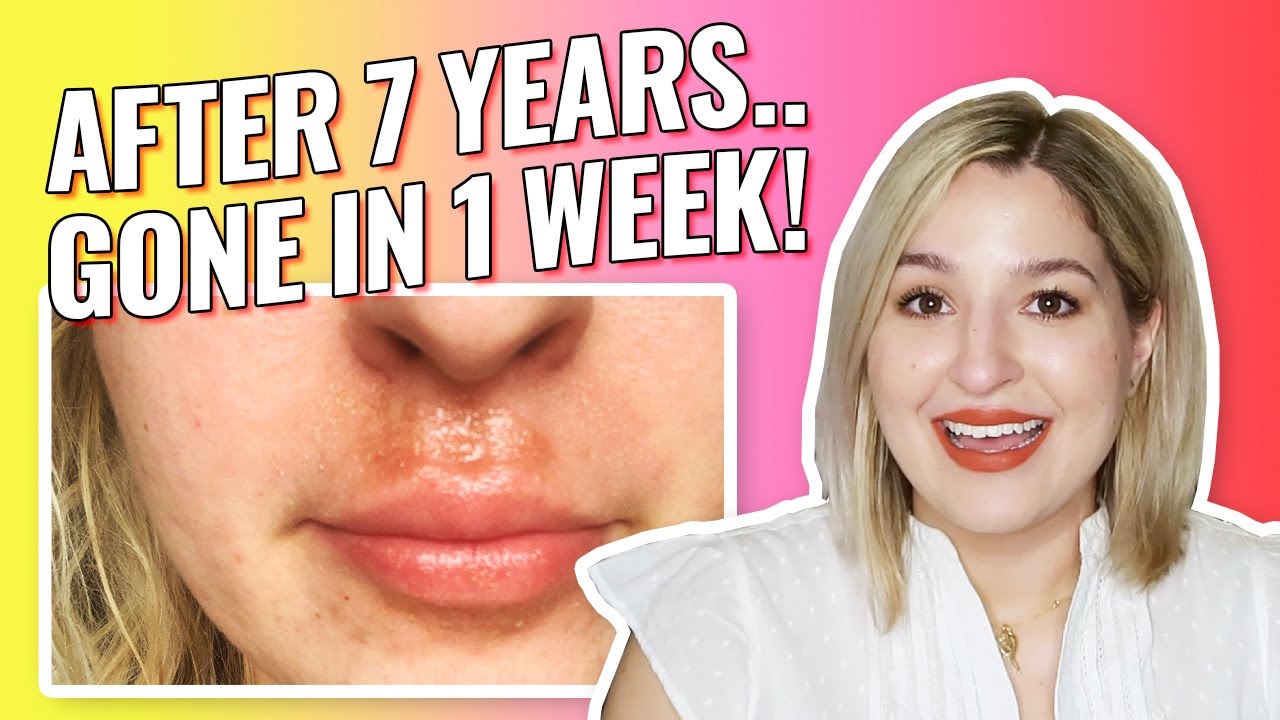 Dermatitis Around My Lips Lipstutorial Org