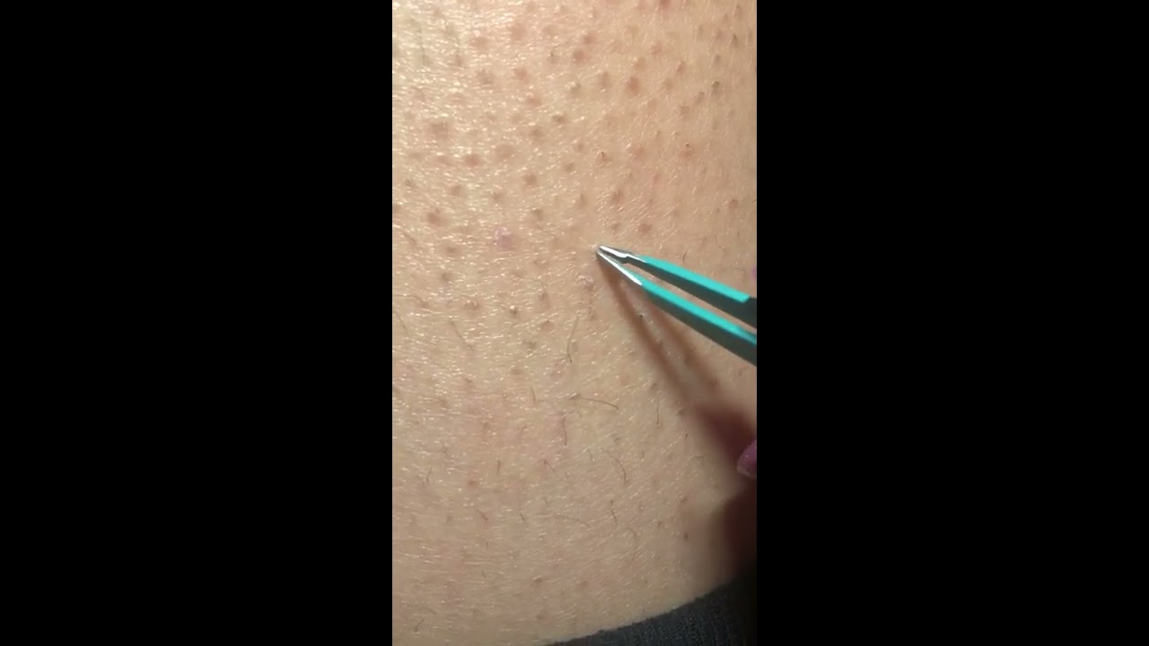 Ingrown Hair Removal Youtube