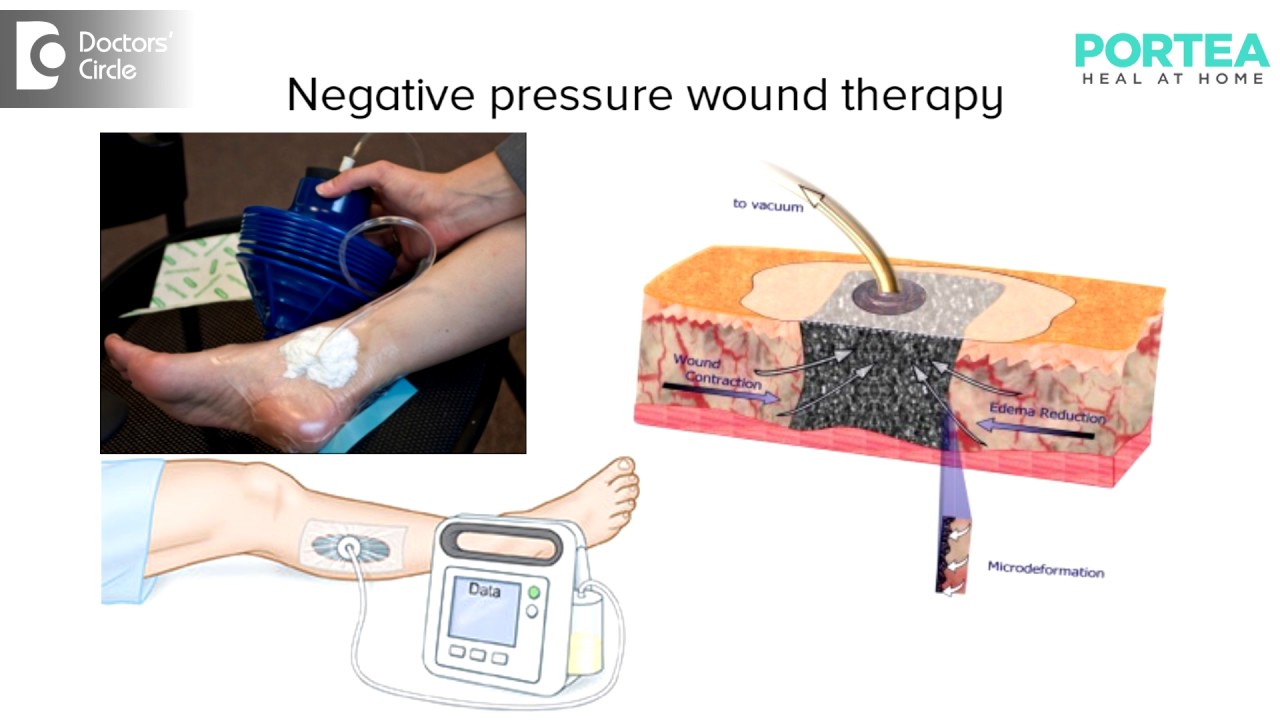 Safe Negative Pressure Wound Therapy The Wound Vac 60 Off