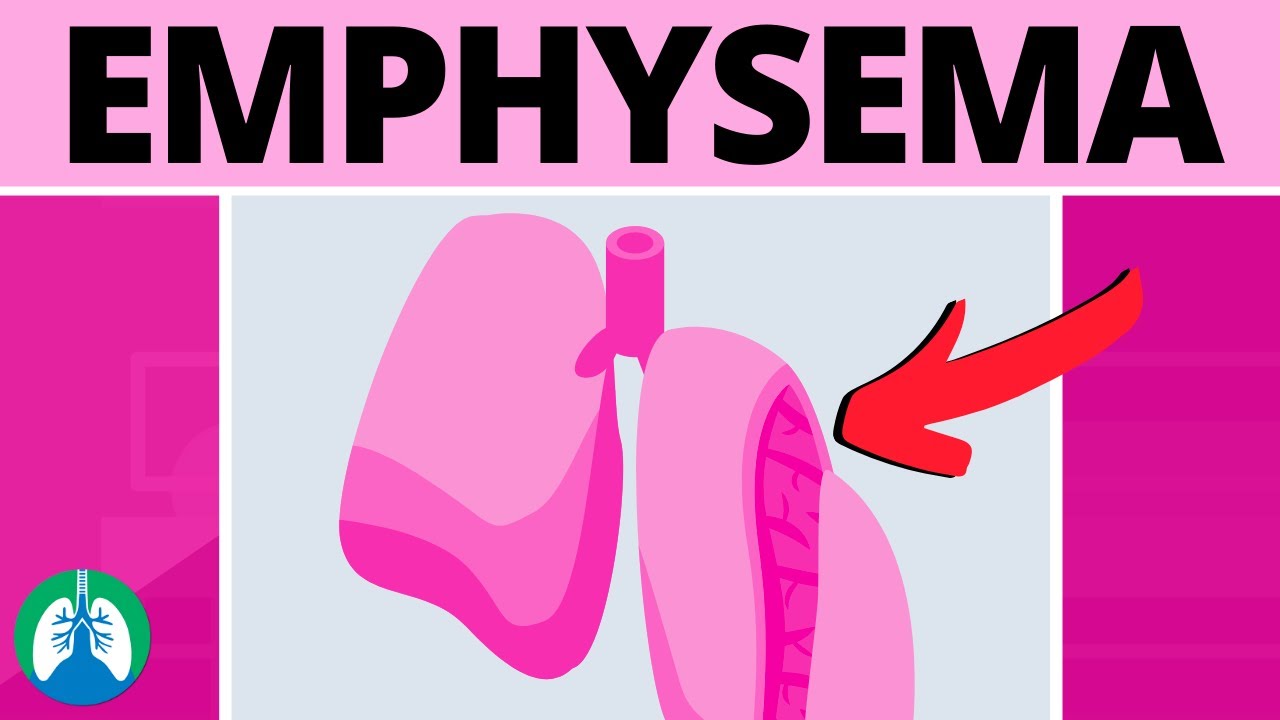 Emphysema Medical Definition Quick Explainer Video Youtube