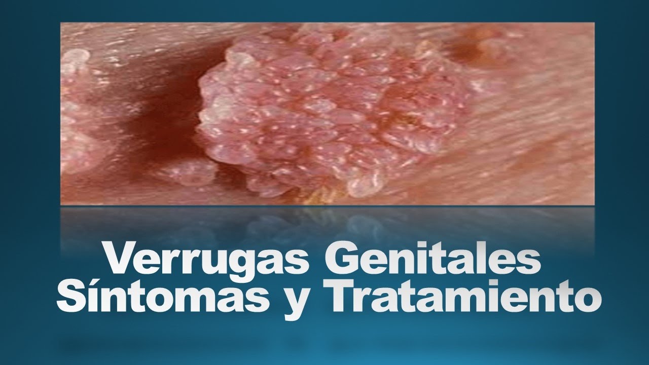 Verrugas Genitales Qué Son Causas Síntomas Prevención Trpd