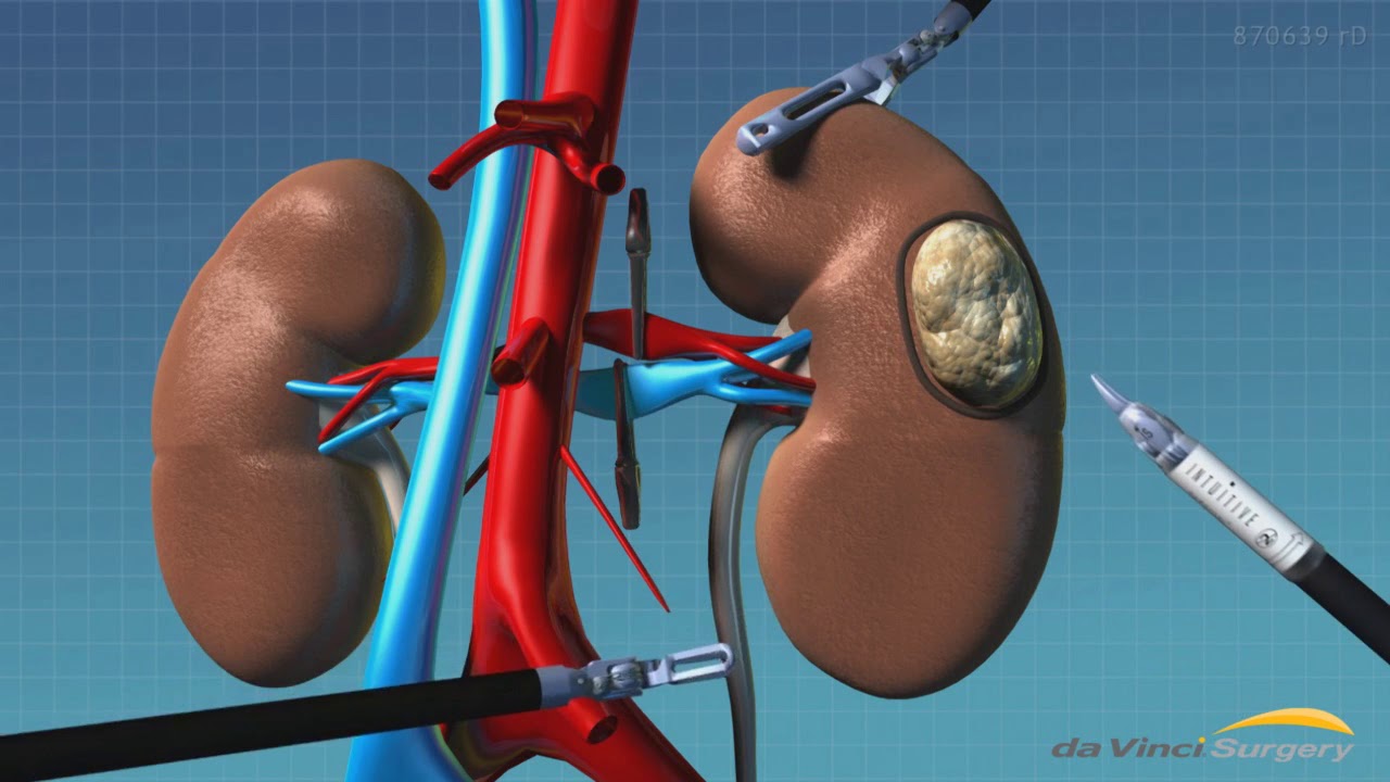 Robotic Davinci Partial Nephrectomy Youtube