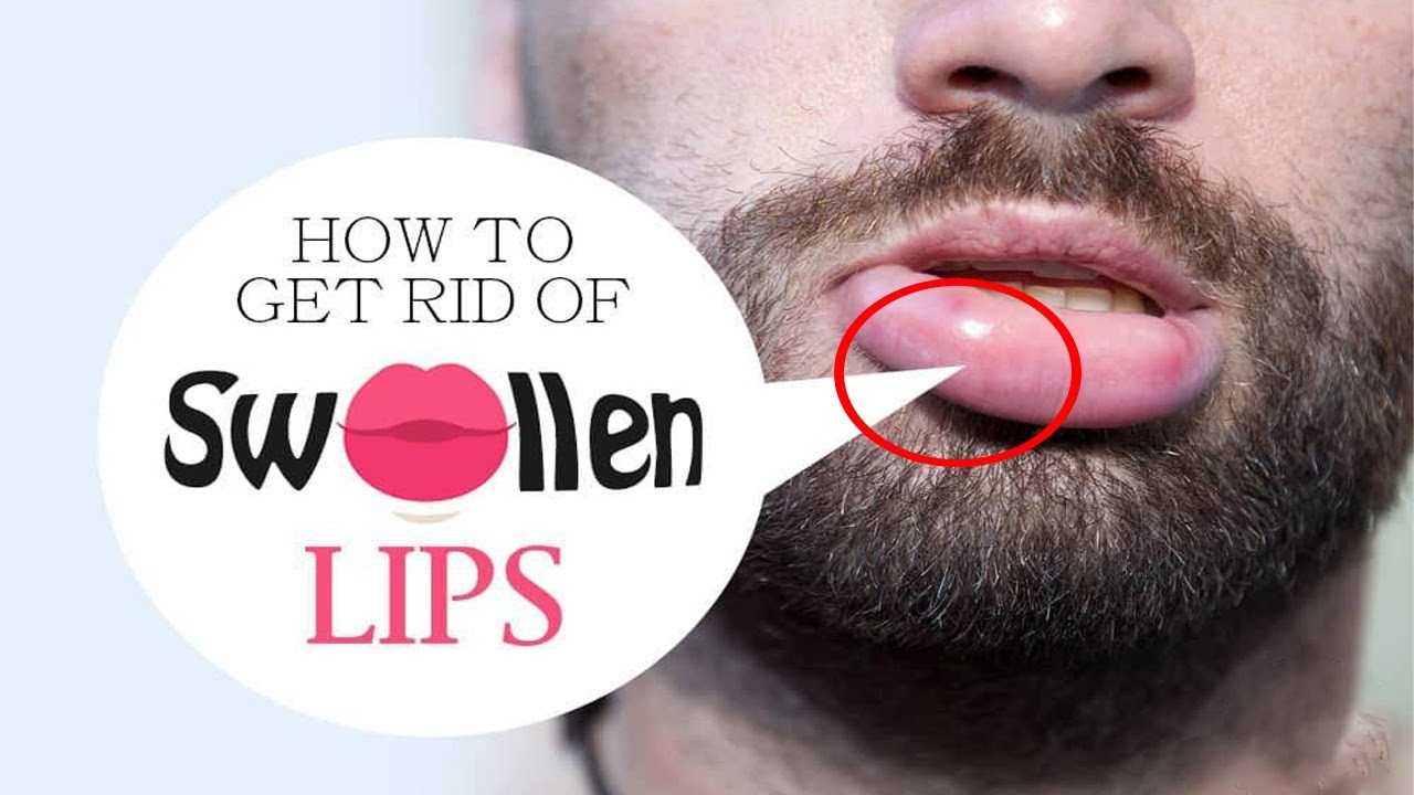 What Allergy Causes Swollen Lips Infoupdate Org