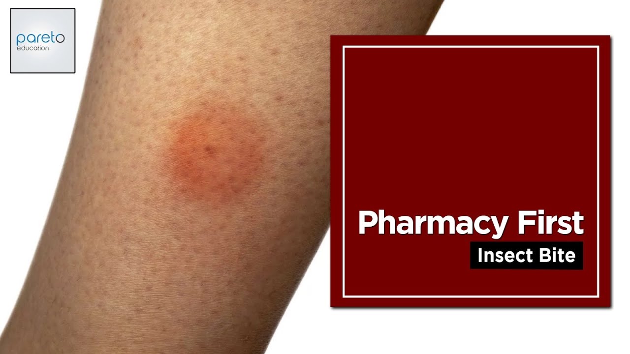 Pharmacy First Insect Bite Pareto Education Youtube