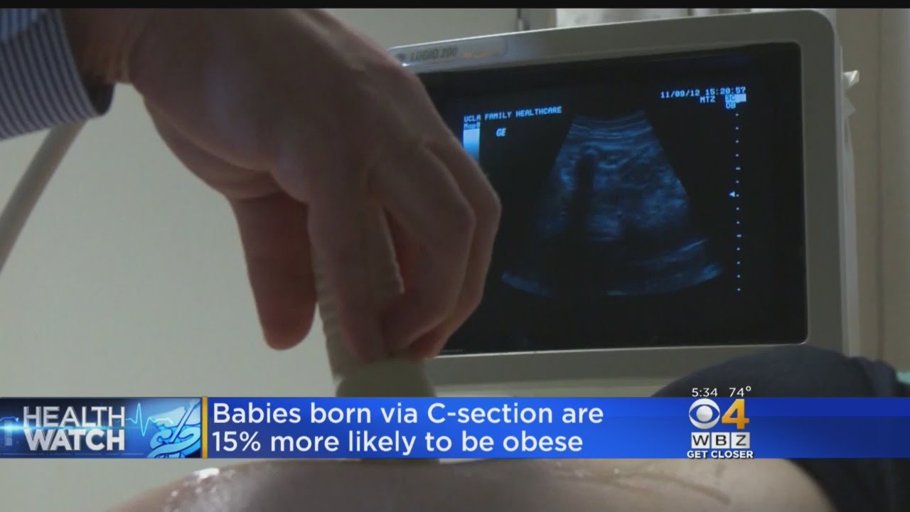 Babies Born By C Section More Likely To Be Obese Study Finds Youtube