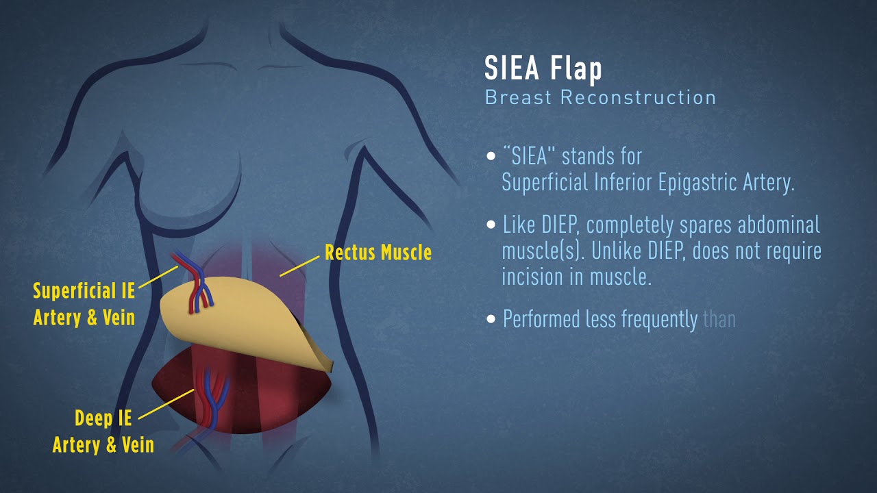 How Does A Diep Flap Work At Liam Dun Blog