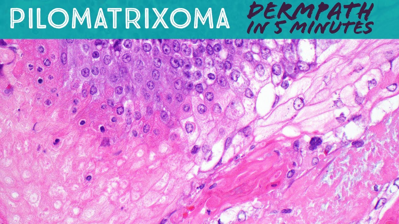 Pilomatrixoma Pilomatricoma Dermpath In 5 Minutes Dermatology
