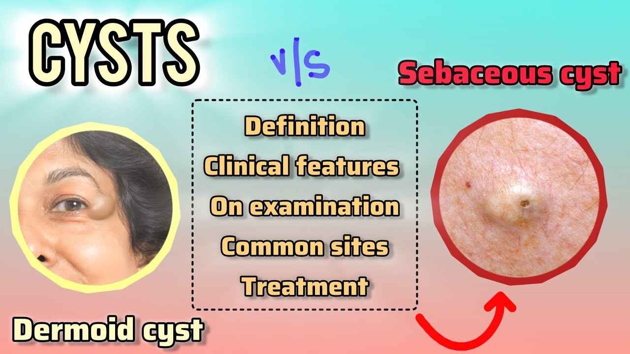 Cysts Dermoid Cyst Types Sebaceous Cyst General Surgery Youtube