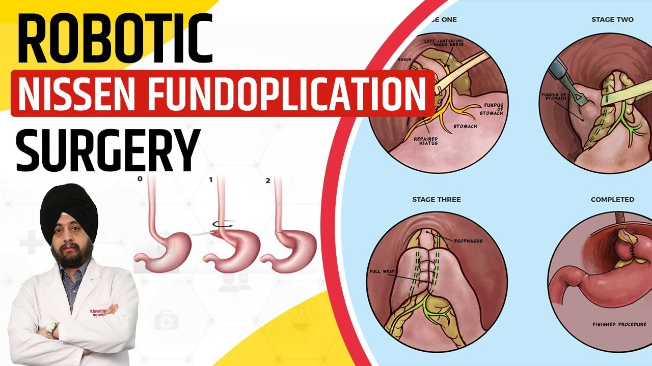 Robotic Nissen Fundoplication In Hindi For Hiatus Hernia And Reflux