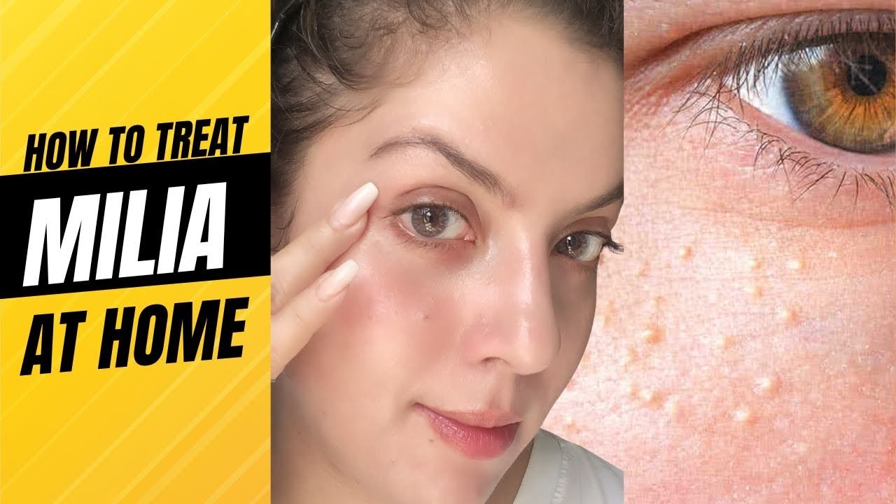 Milia Treatment I How To Treat Milia At Home How To Treat Milia Under