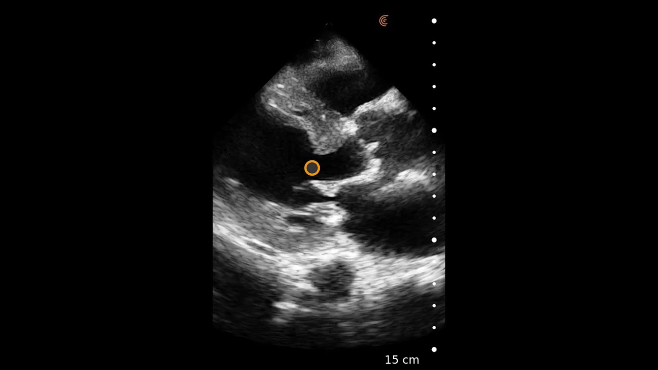 Left Ventricular Hypertrophy An Overview Sciencedirect 44 Off