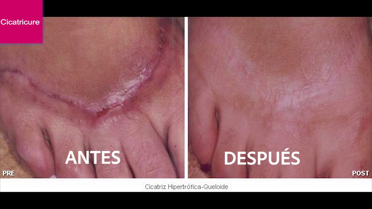 Cicatrices Antes Y Después Con Cicatricure Youtube