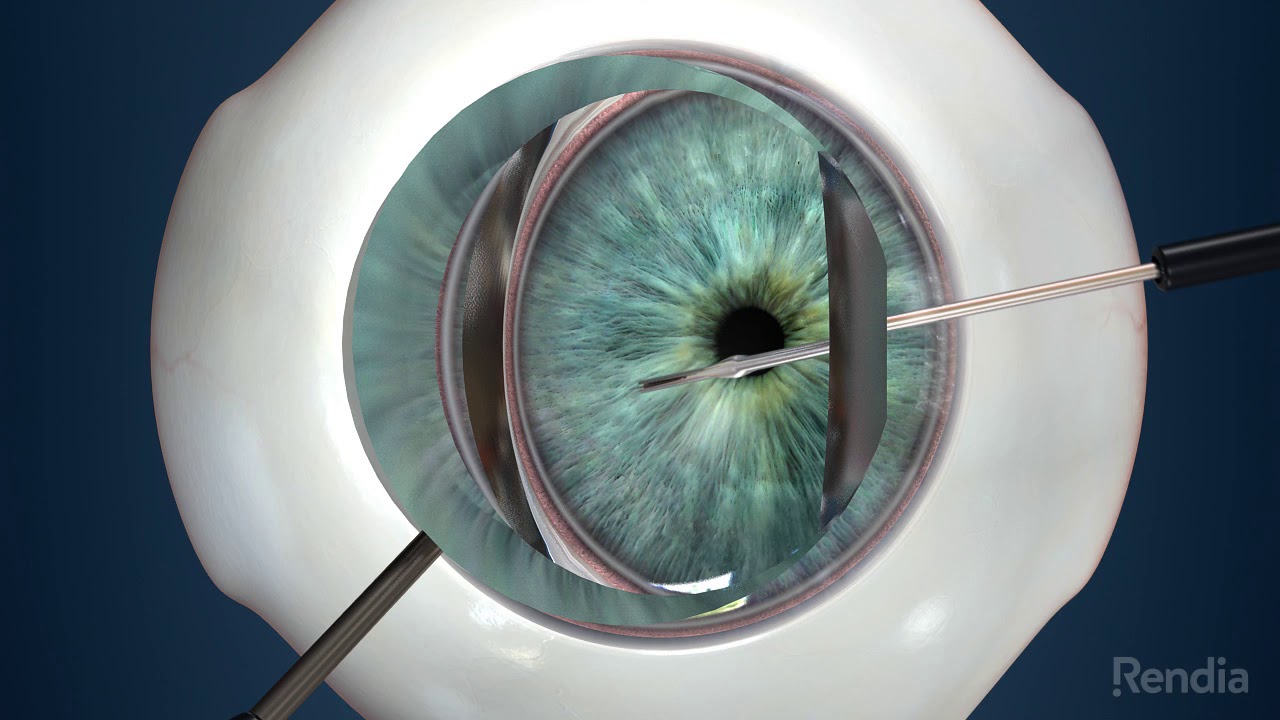 Istent Inject Trabecular Bypass Procedure Animation Youtube