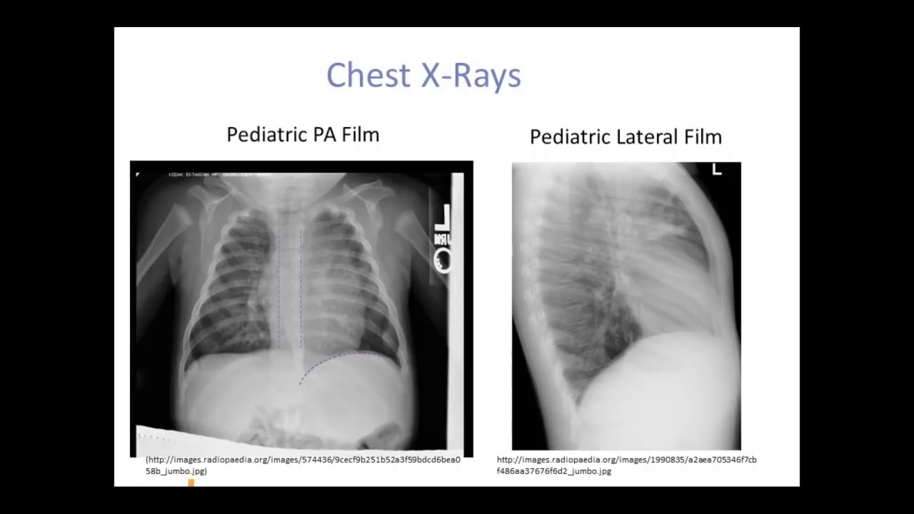 Pediatric Chest Xray Interpretation Back To Basics Lung