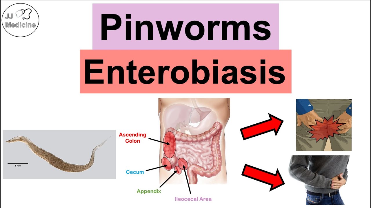 Pinworms Enterobiasis Infection Transmission Symptoms Diagnosis