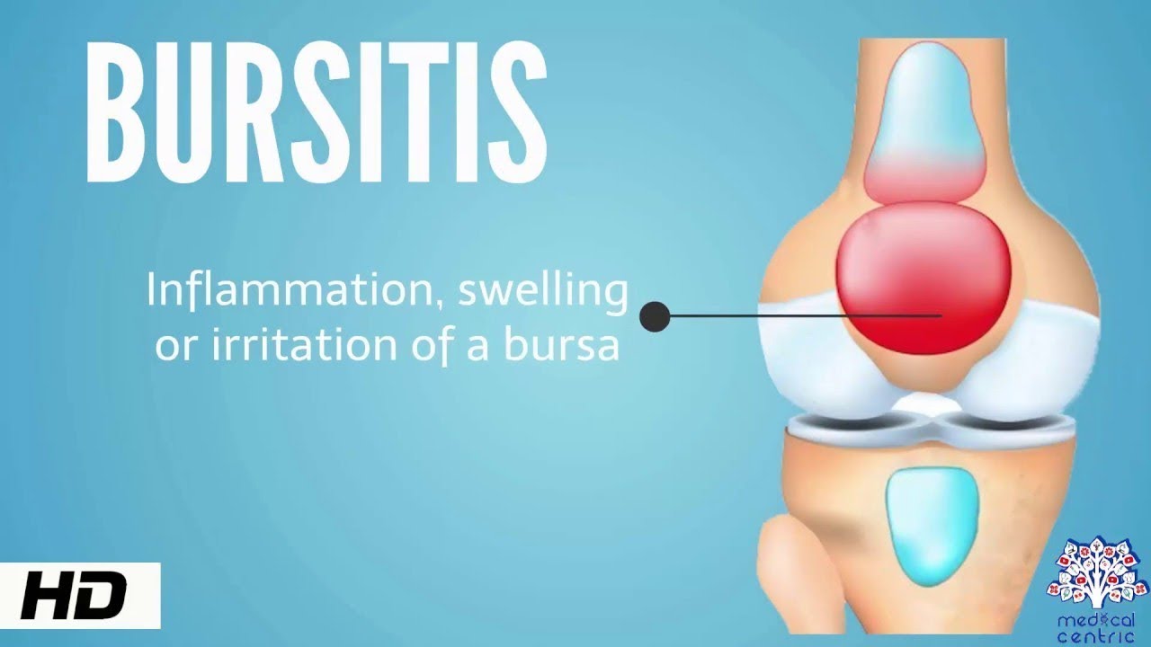 Knee Bursitis Causes Symptoms And 7 Ways To Treat It Fast