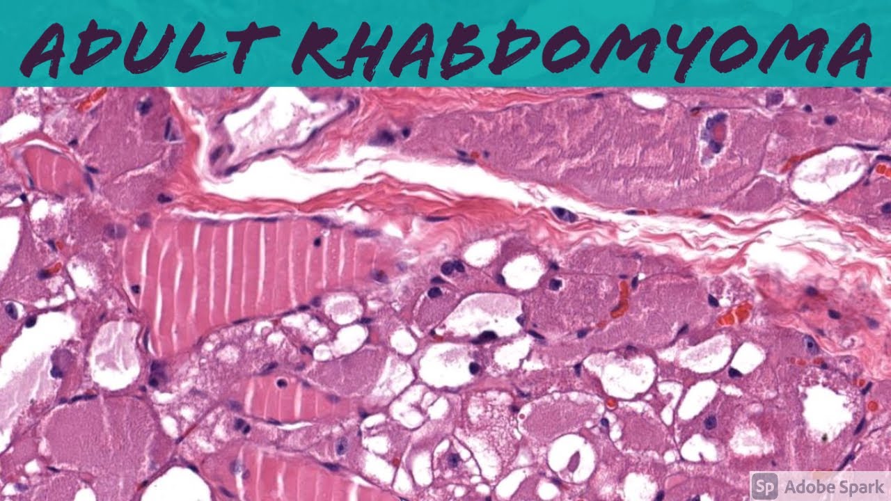 Rhabdomyoma