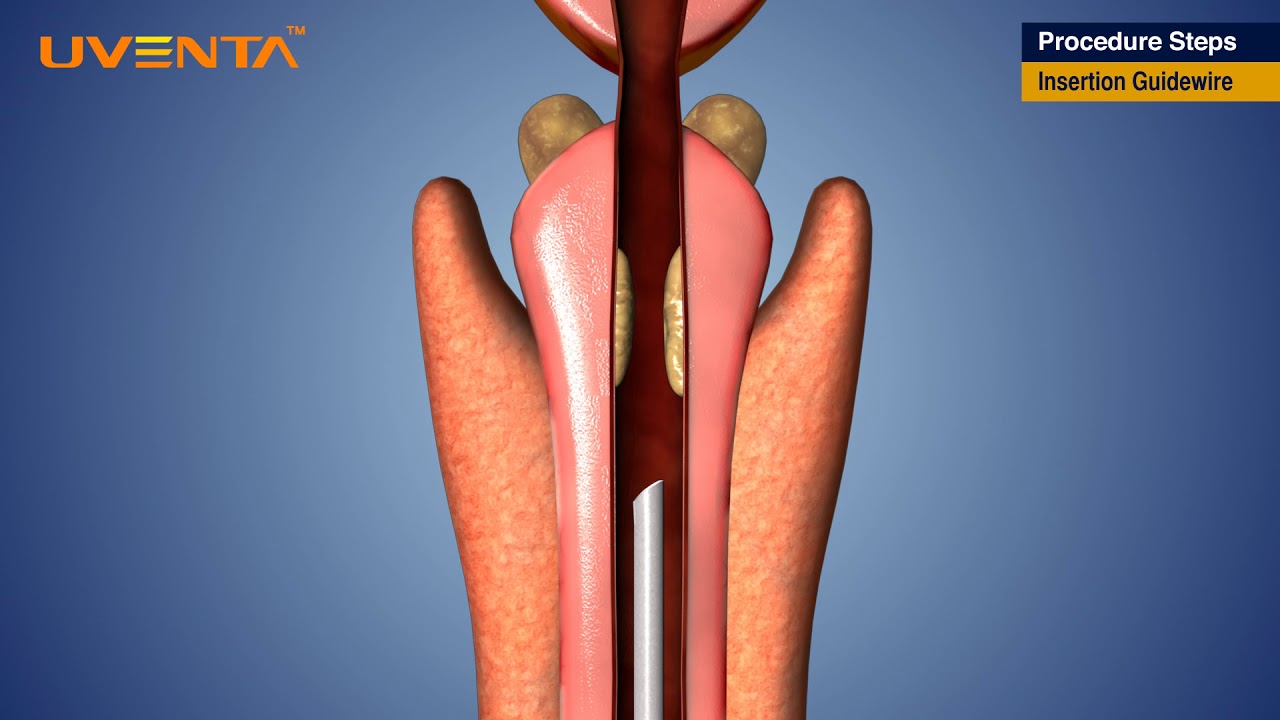 Uventa邃 Urethral Stent Youtube