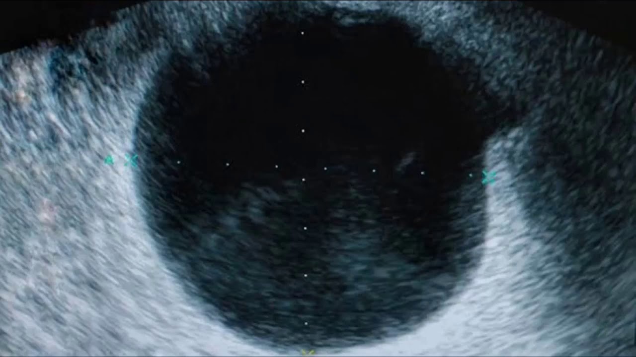Quistes De Ovario Foliculares Y Quistes Del Cuerpo Lúteo Signos Y