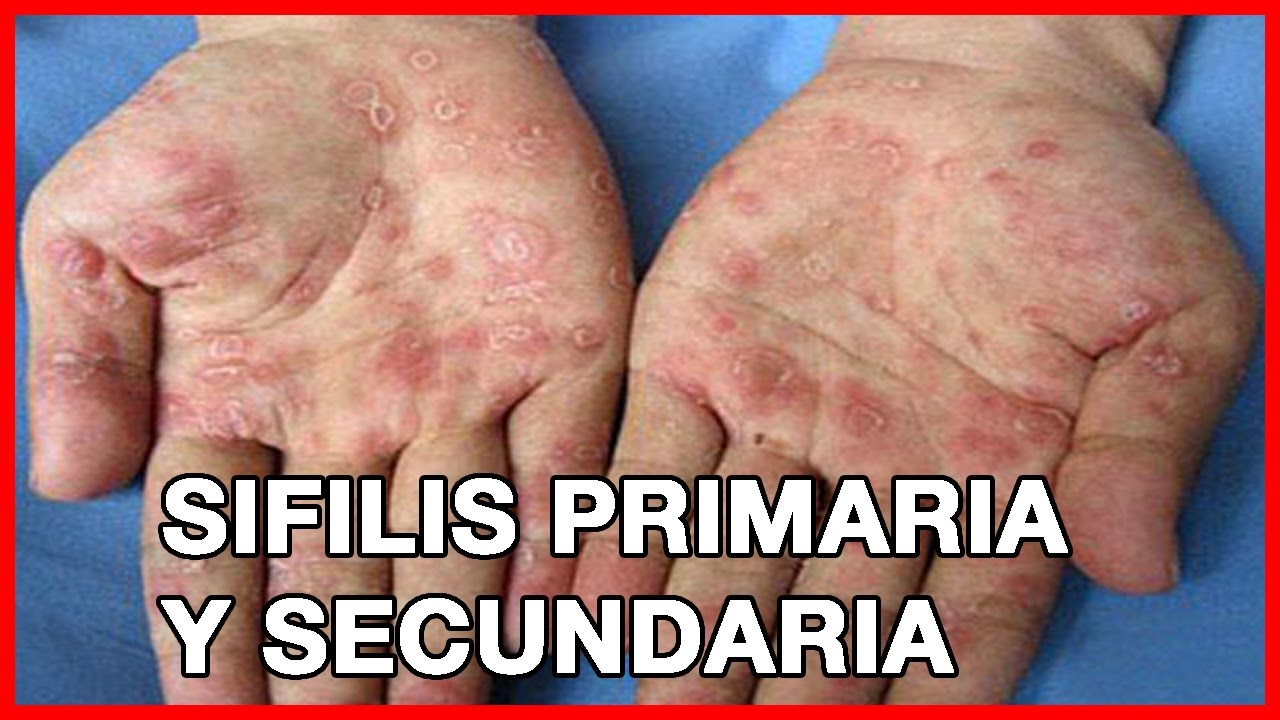 Qué Es La Sífilis Tipos De Sífilis Youtube