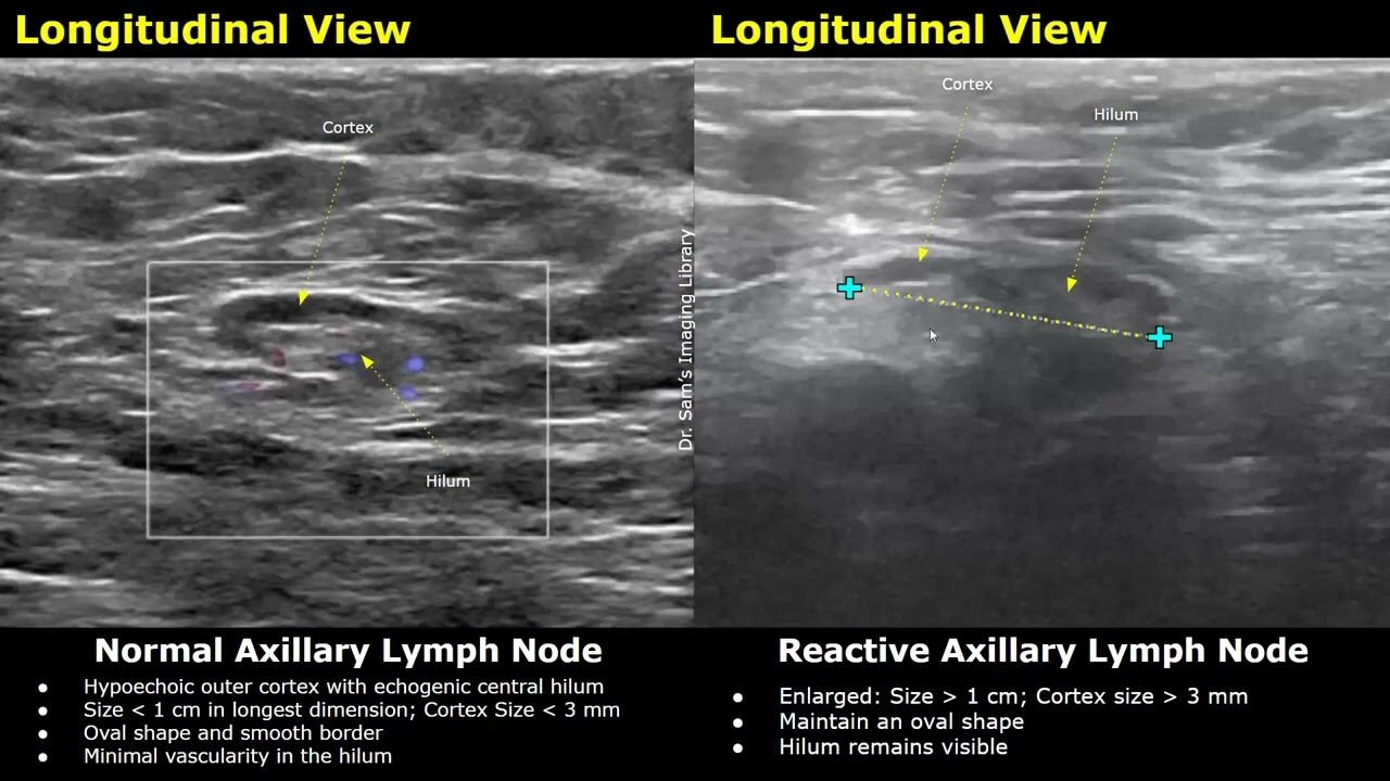 Figure 1 From Imaging Axillary Lymph Nodes In Patients