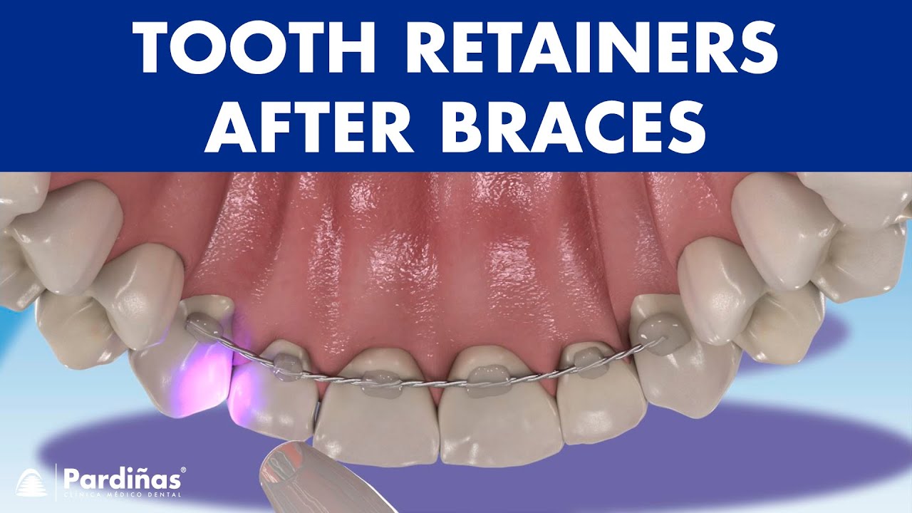 Different Types Of Retainers After Braces
