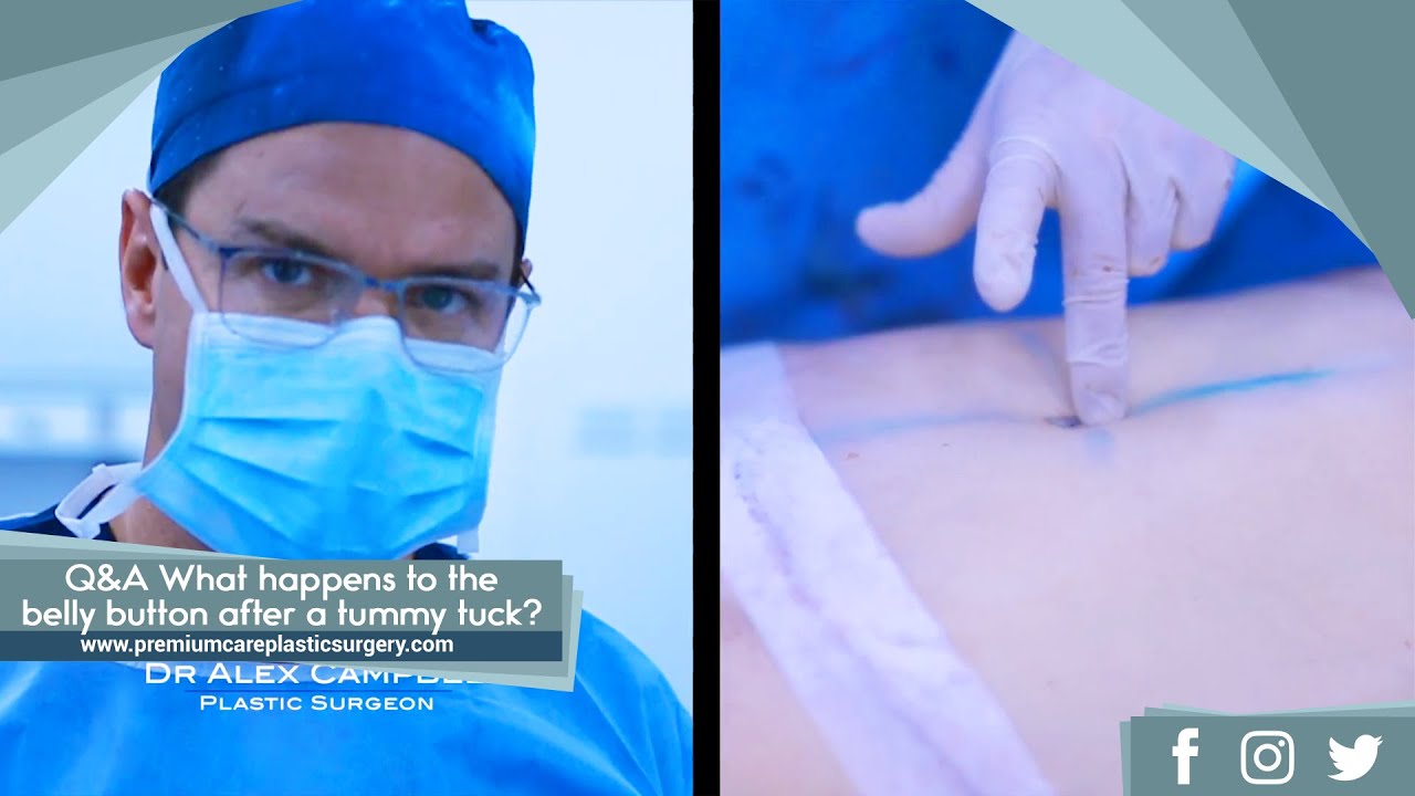 Q A What Happens To The Belly Button After A Tummy Tuck Youtube