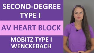 Second Degree Type I Av Heart Block Nursing Nclex Ecg Mobitz Type 1 ...