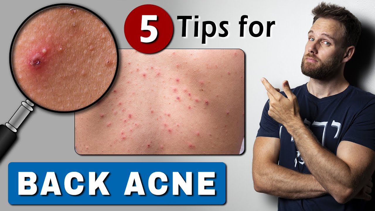 Pimples On Back
