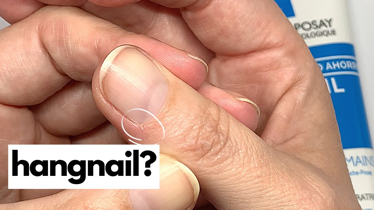Hangnails Emergency Fix Youtube