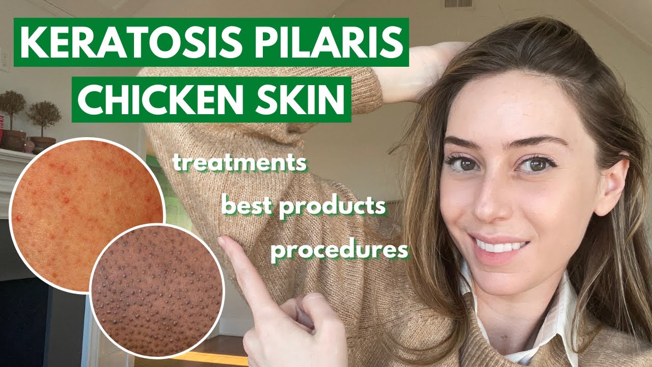 Keratosis Pilaris Chicken Skin Treatment At Felix Lesperance Blog