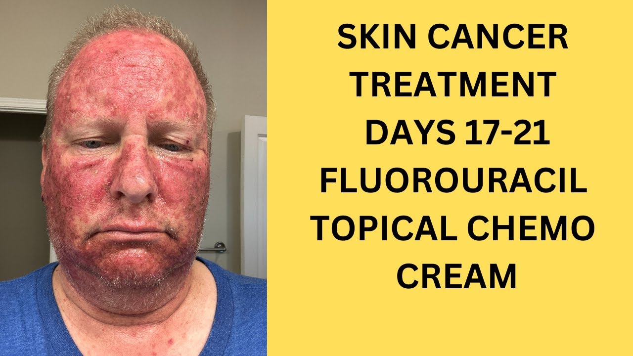 Skin Cancer Treatment Fluorouracil Day 17 Thru 21 Youtube