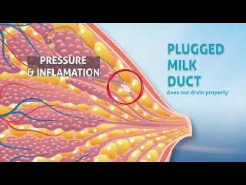 6 Breastfeeding Plugged Milk Ducts Youtube