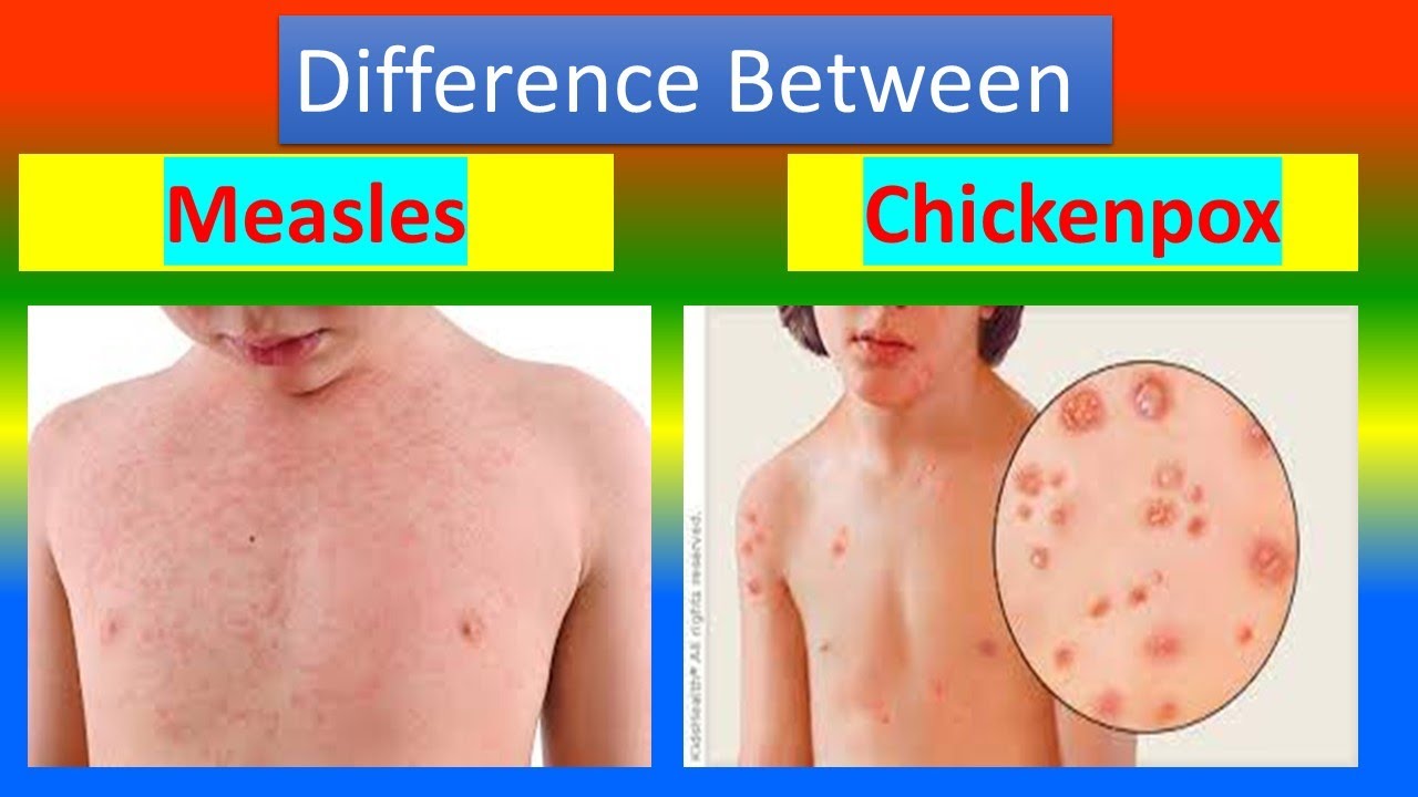 Head And Shoulders On Chicken Pox At Jane Shepherd Blog