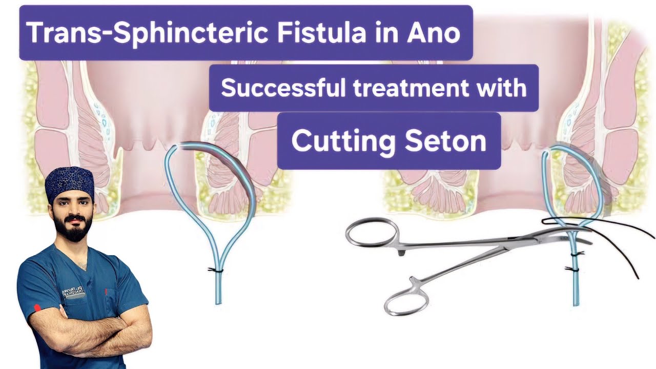 Medical Pictures Of Anal Fistula In Humans