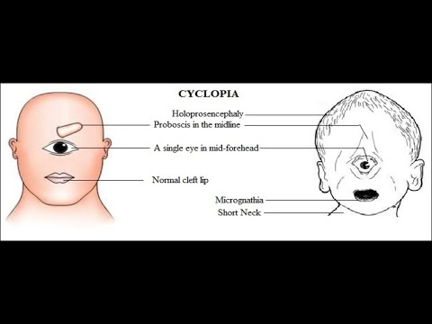 Holoprosencephaly Cyclopia Embryological Basis Causes Features