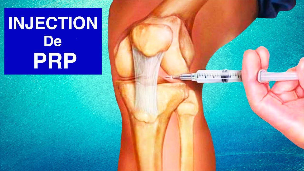 Arthrose Du Genou Injection De Prp Plasma Riche En Plaquettes Youtube