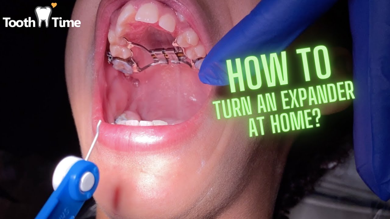 How To Turn An Expander For Braces At Benjamin Macbain Blog